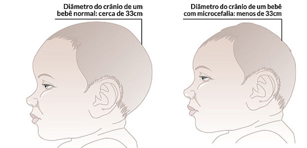 Neuropediatra diz que casos de microcefalia indicam uma nova doença ...