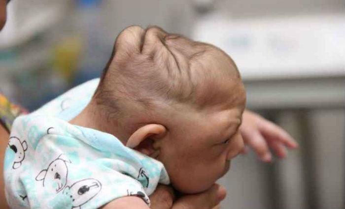 Após nascimento, bebês com zika desenvolvem microcefalia, diz estudo ...