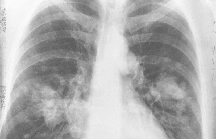 Entenda o adenocarcinoma, câncer de pulmão de Ana Maria Braga | Ciência ...